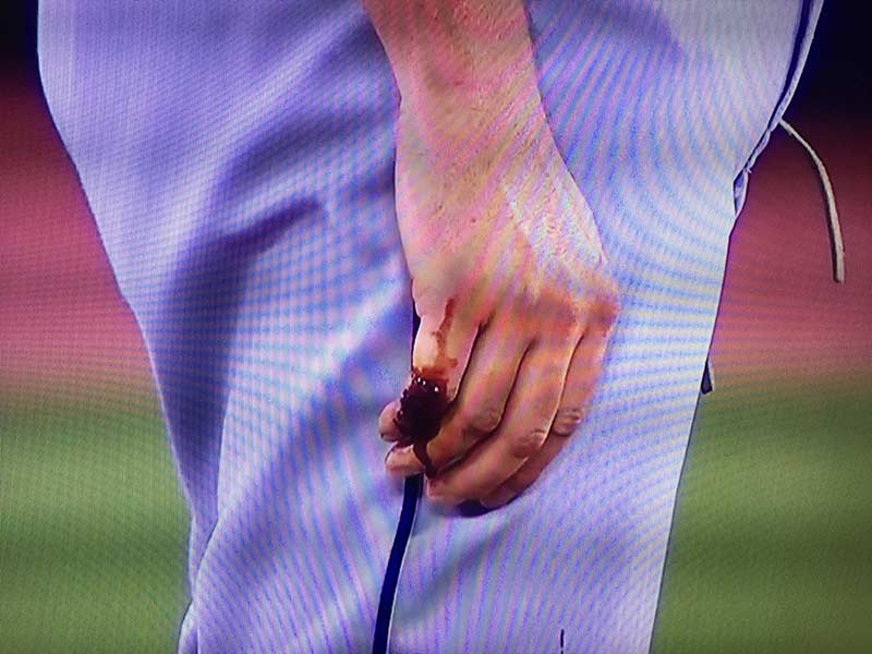 20 Weird Sports Injuries - Oddee