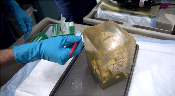 10 Absolutely Bizarre Cases of Amnesia - "bizarre," "amnesia," "brain ...