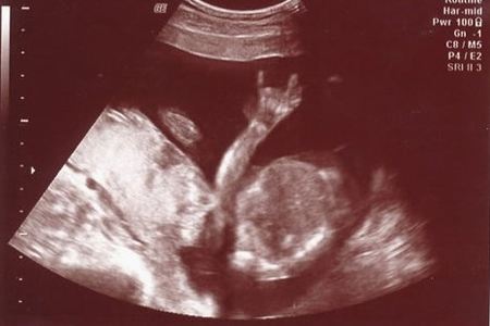 Ultrassom Octupleto UNIVERSIDADE FEDERAL DO ESPÍRITO SANTO CENTRO DE